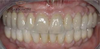 Protesi fisse su impianti – Studio Dentistico Dott. Carboncini – Siena ...