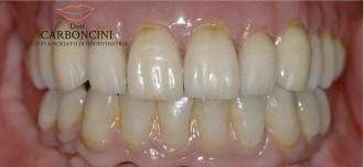 Protesi fisse su impianti – Studio Dentistico Dott. Carboncini – Siena ...